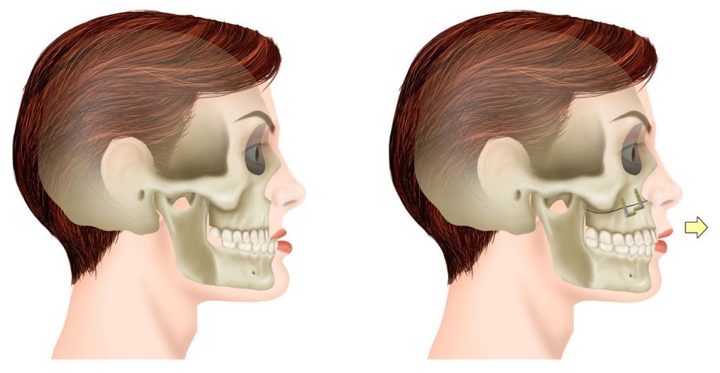 Cirurgia Ortognática - Augusto Pary